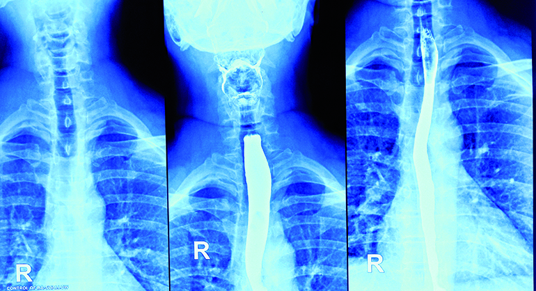 Disfagia: la epidemia silenciosa que afecta a más de dos millones de ...